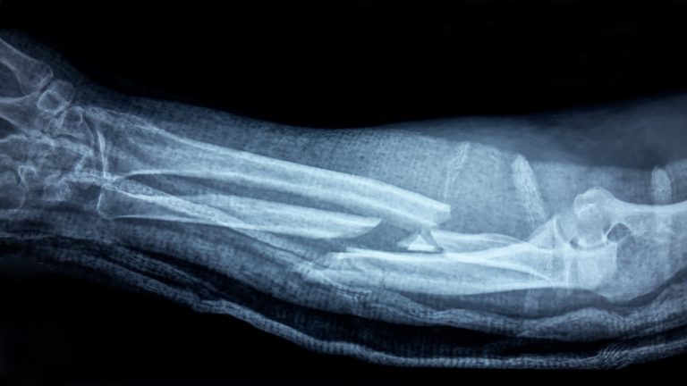 fractura - Dr. Trujillo Amador